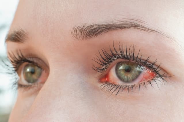 Can Alcohol Cause Bloodshot Eyes: Should I Be Concerned? | Zinnia Health