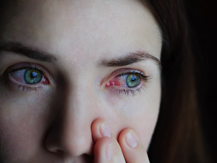 How to Get Rid of Stoned Eyes | Zinnia Health